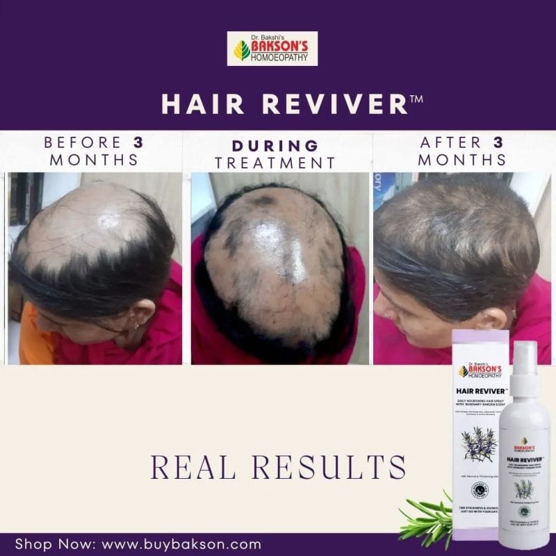 BAKSON Hair Reviver | Hair Care & Regrowth Treatment – Dr Homoeo Pharmacy